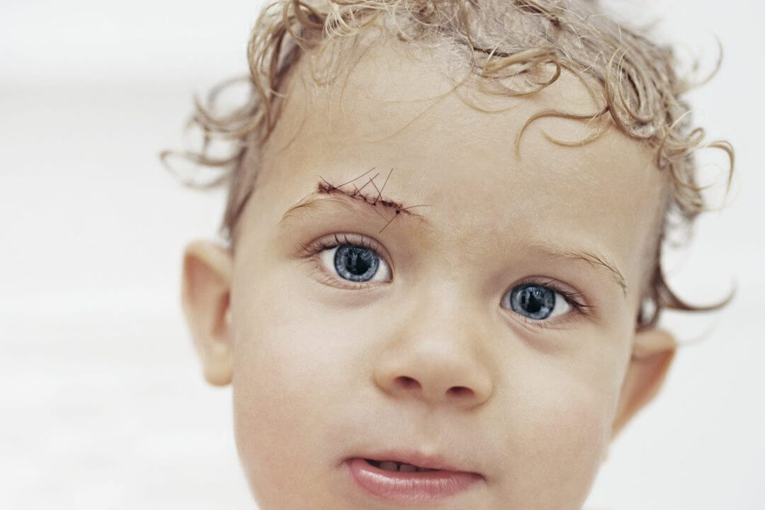 Parenting Tips – Does My Child Need Stitches? | Pediatrics Of Florence
